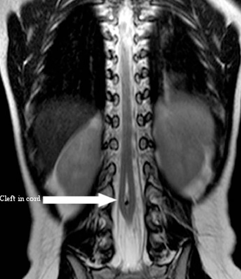 Know your spinal cord – Diastematomyelia | Lunatic Laboratories
