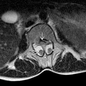 Know your spinal cord – Diastematomyelia | Lunatic Laboratories