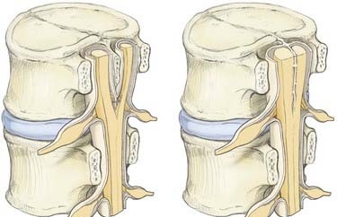 Know your spinal cord – Diastematomyelia | Lunatic Laboratories