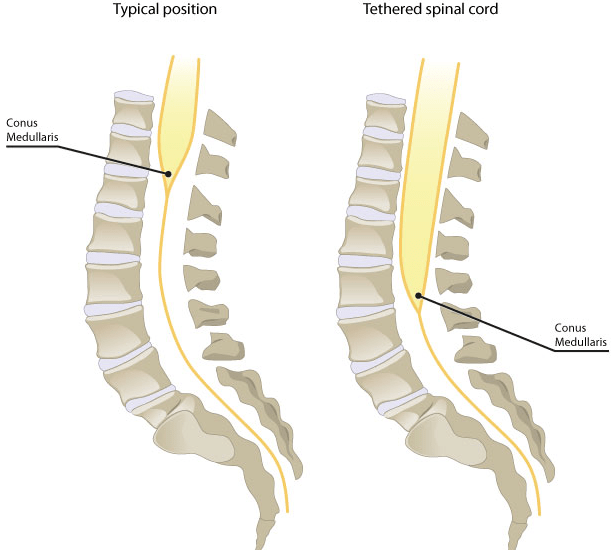 Know your spinal cord – The tethered spinal cord | Lunatic Laboratories