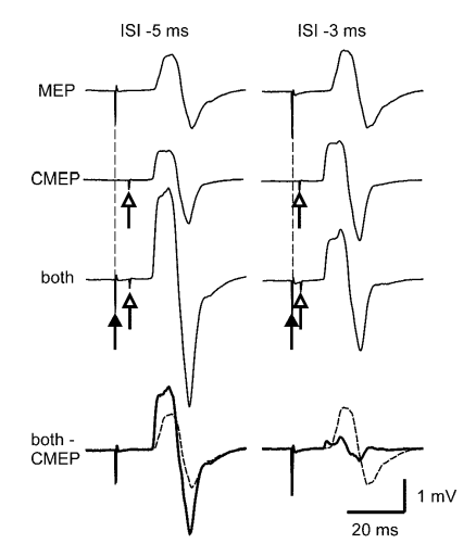 Know your spinal cord – Cervicomedullary motor evoked potentials ...